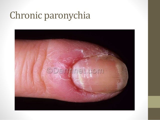 Paronychia