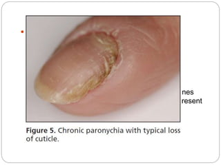 Paronychia | PPTX | Skin and Dermatology | Diseases and Conditions