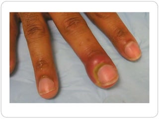 Paronychia | PPTX
