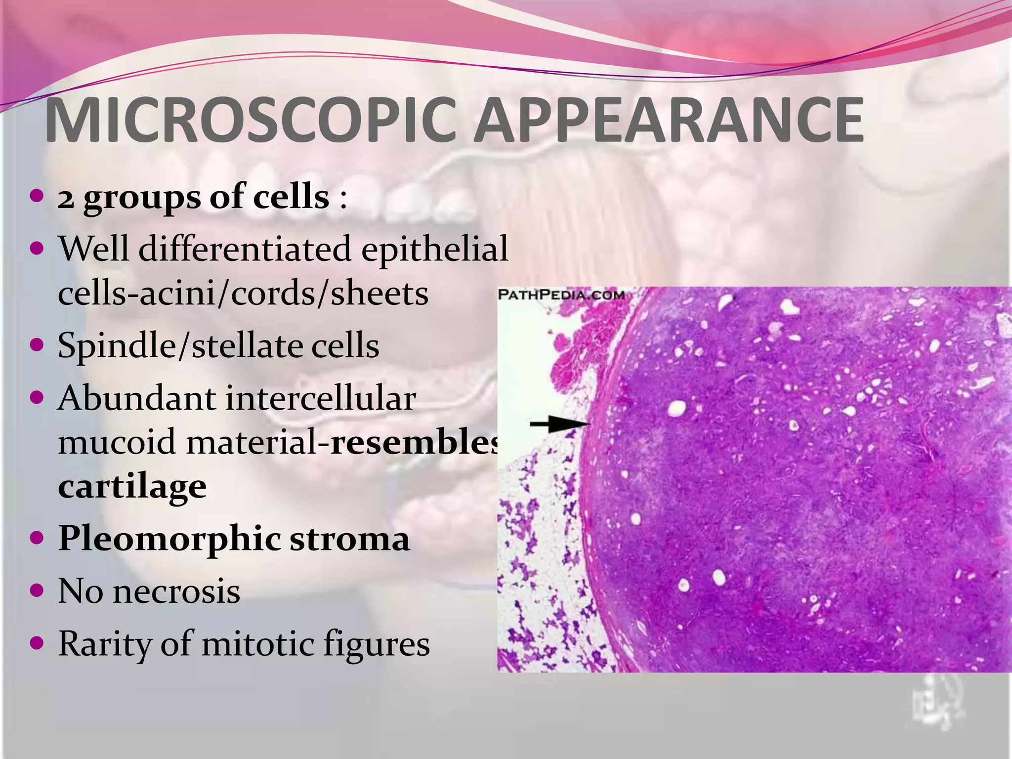 Pleomorphic adenoma | PPTX