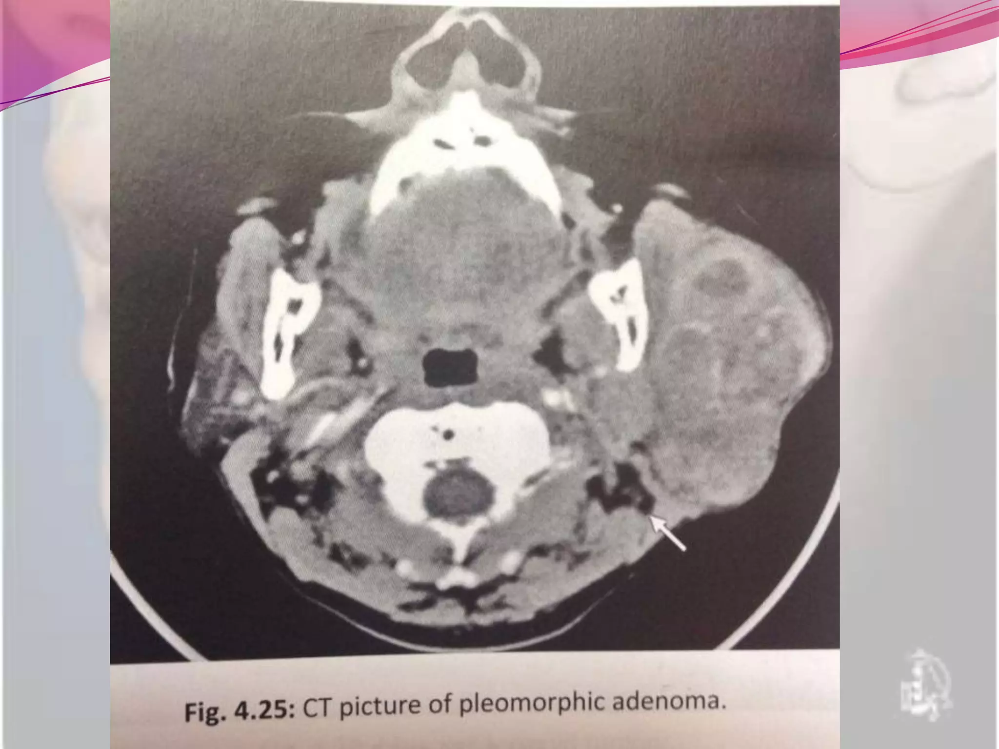 Pleomorphic adenoma | PPTX