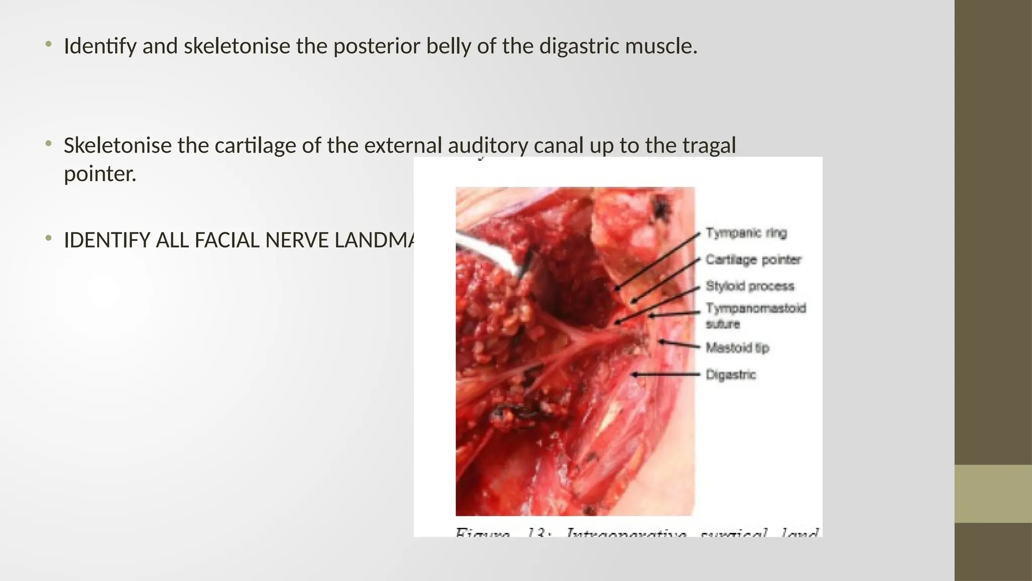 parotid carcinoma in details of parotid CA | PPTX