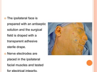 Parotidectomy | PPTX