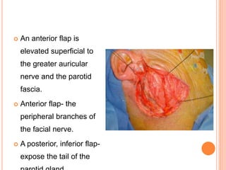 Parotidectomy | PPTX