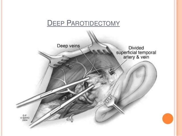 Parotidectomy