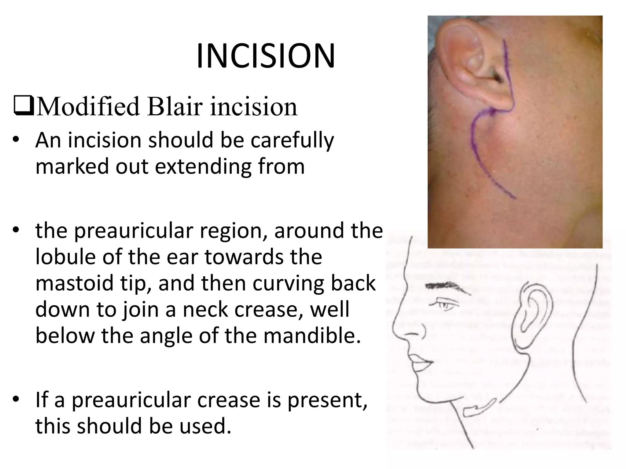 Parotidectomy | PPTX