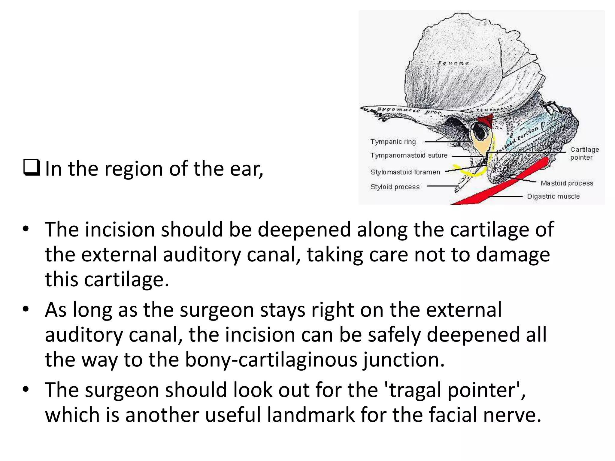 Parotidectomy | PPTX