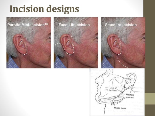 Parotidectomy | PPTX | Ear, Nose and Throat Conditions | Diseases and ...