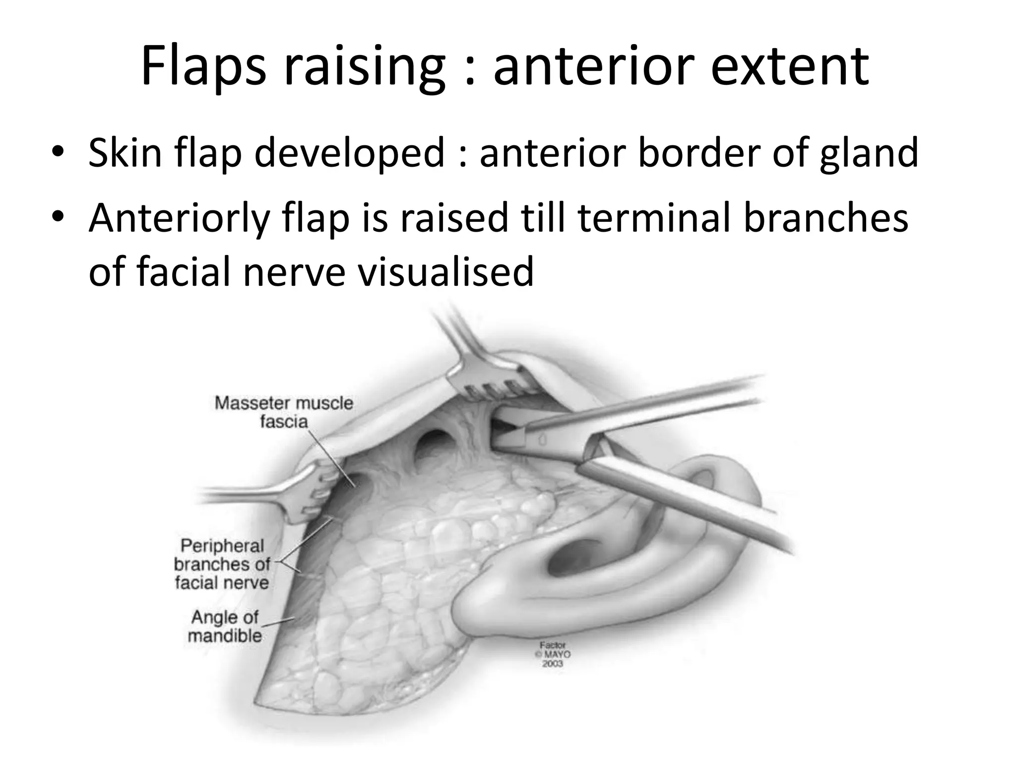 Parotidectomy : Operative Technique | PPTX