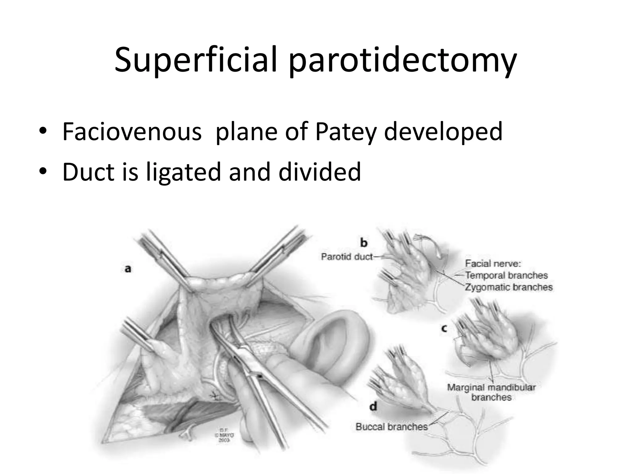 Parotidectomy : Operative Technique | PPTX