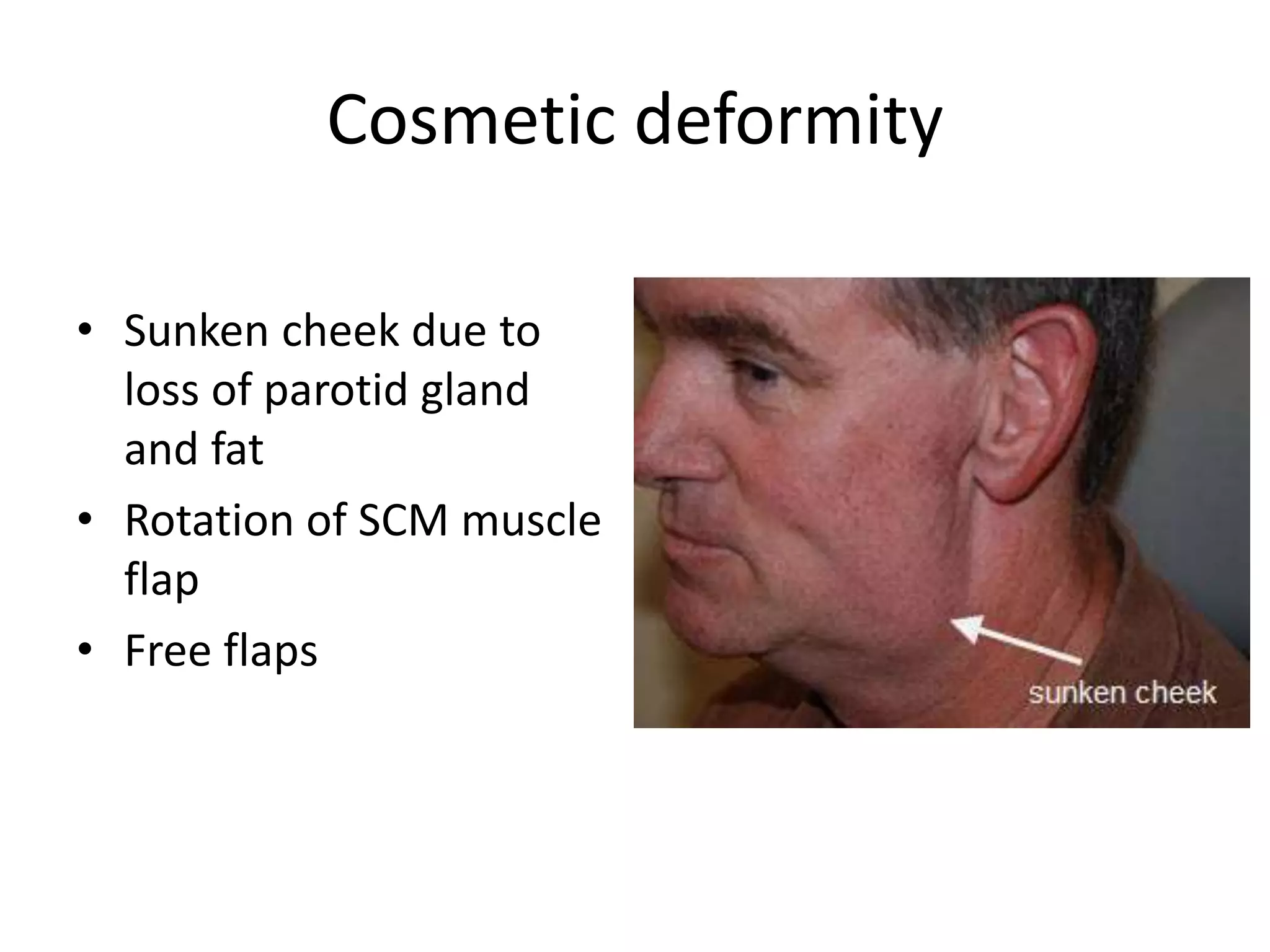 Parotidectomy : Operative Technique | PPTX