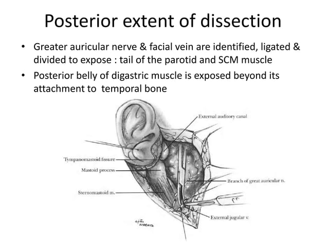 Parotidectomy : Operative Technique | PPTX