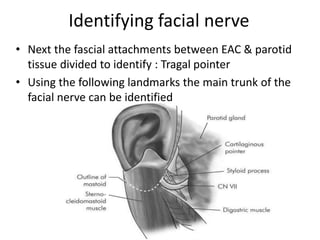 Parotidectomy : Operative Technique | PPTX