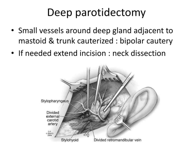 Parotidectomy : Operative Technique | PPTX