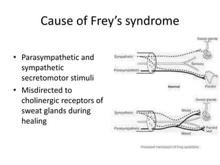 Freys Syndrome