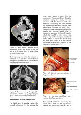 Parotidectomy hegazy | PDF