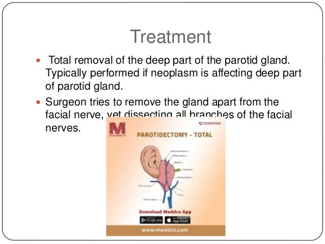 Parotidectomy total | PPTX