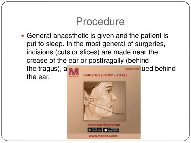 Parotidectomy total | PPTX