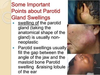 Parotid region swellings | PPTX | Ear, Nose and Throat Conditions ...