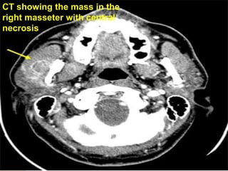 Parotid region swellings | PPTX