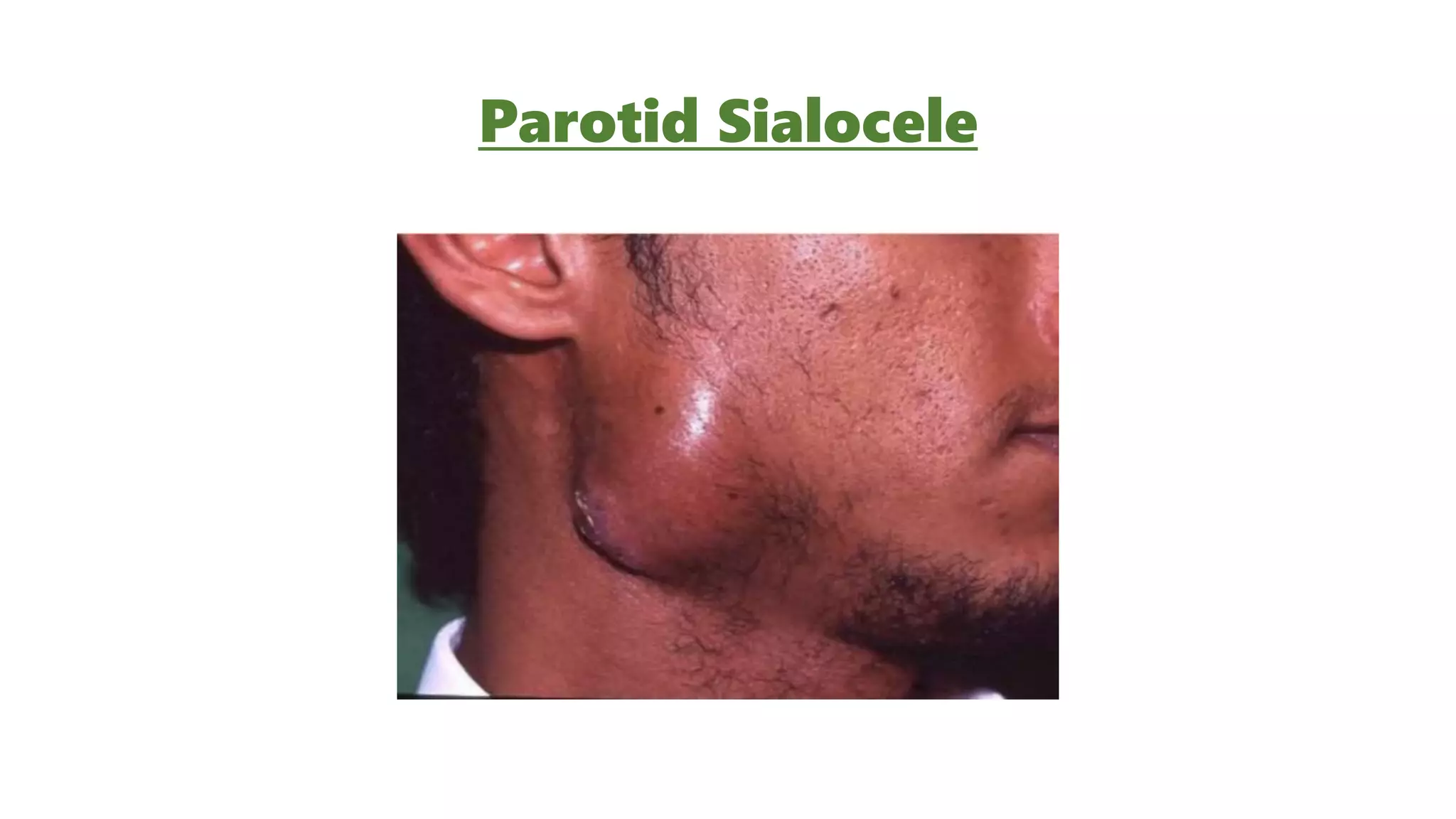 Anatomy of Parotid gland.pptx