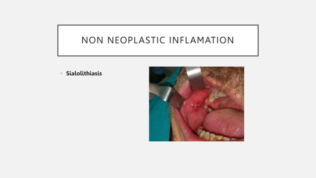 Parotid Gland- Applied anatomy.pptx
