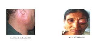 PAROTID GLAND ,its landmarks, salivary pathway | PPTX