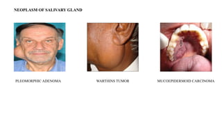 PAROTID GLAND ,its landmarks, salivary pathway | PPTX