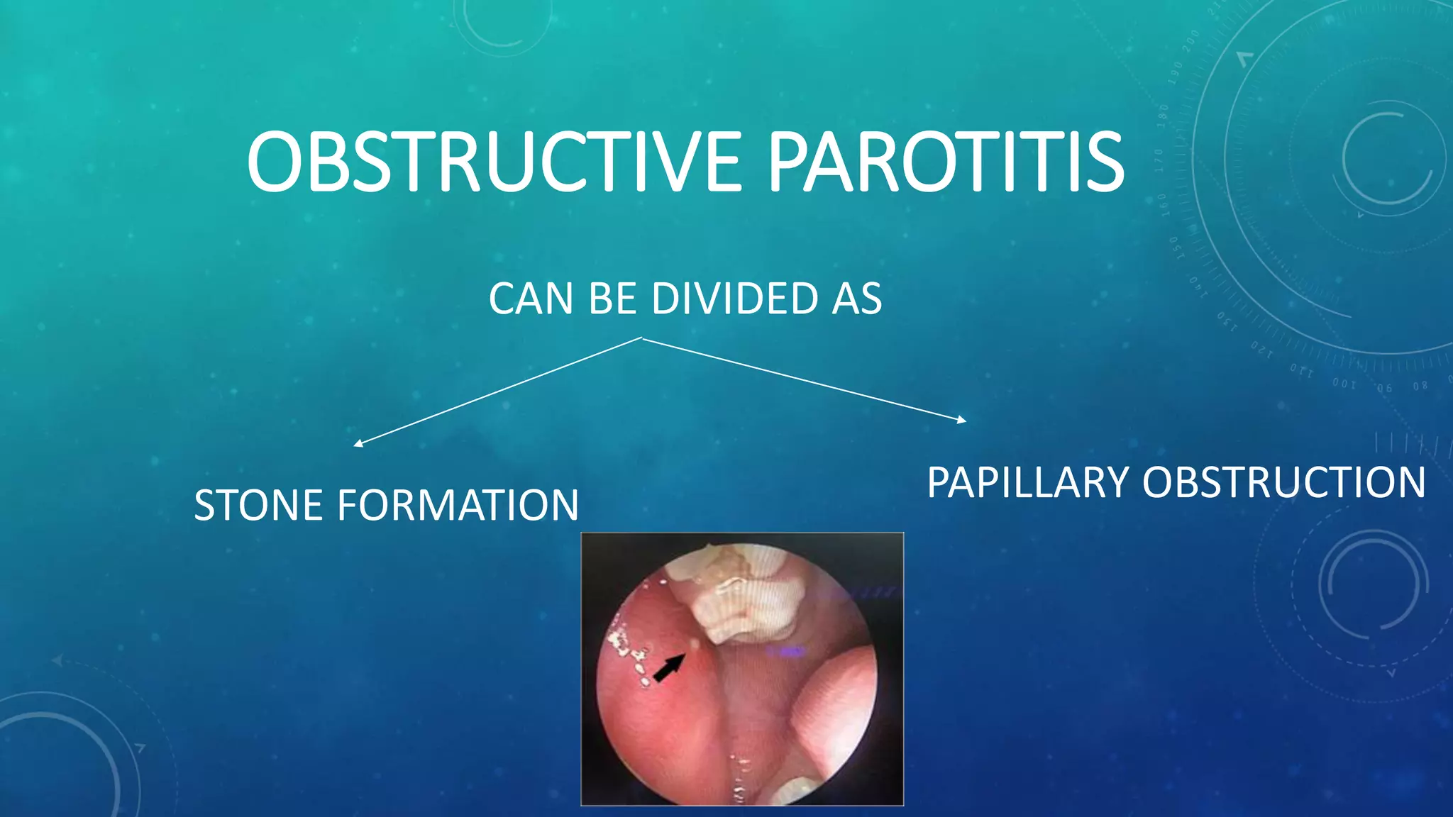 Parotid gland diseases .pptx
