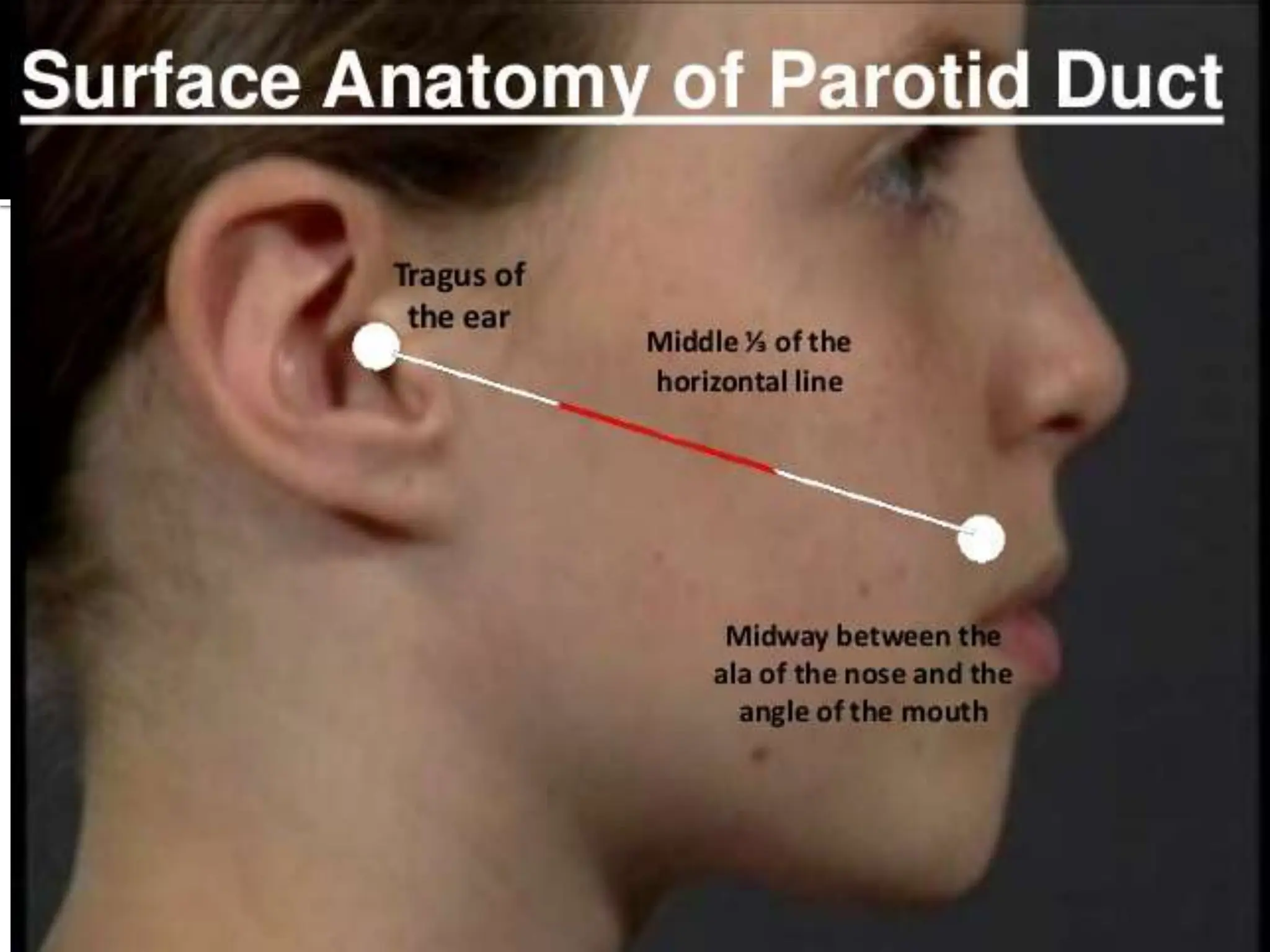 Parotid gland tumor.pptx