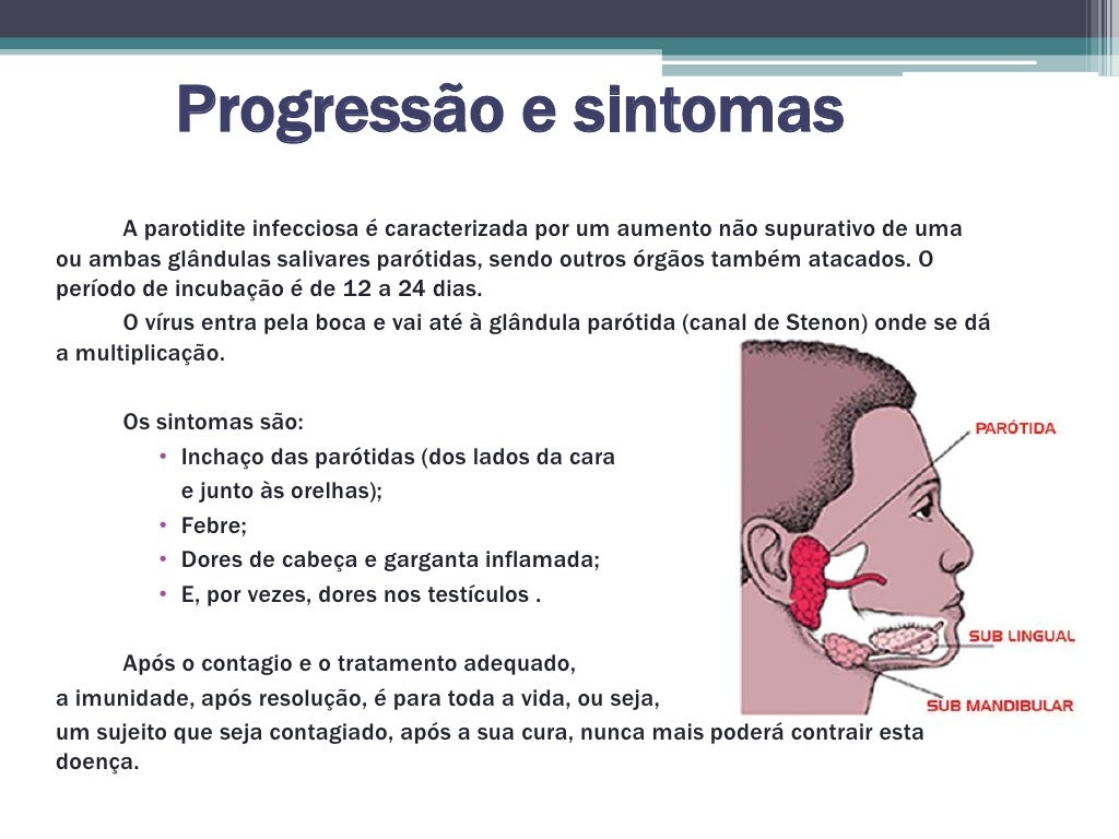 Parotidite Epidémica