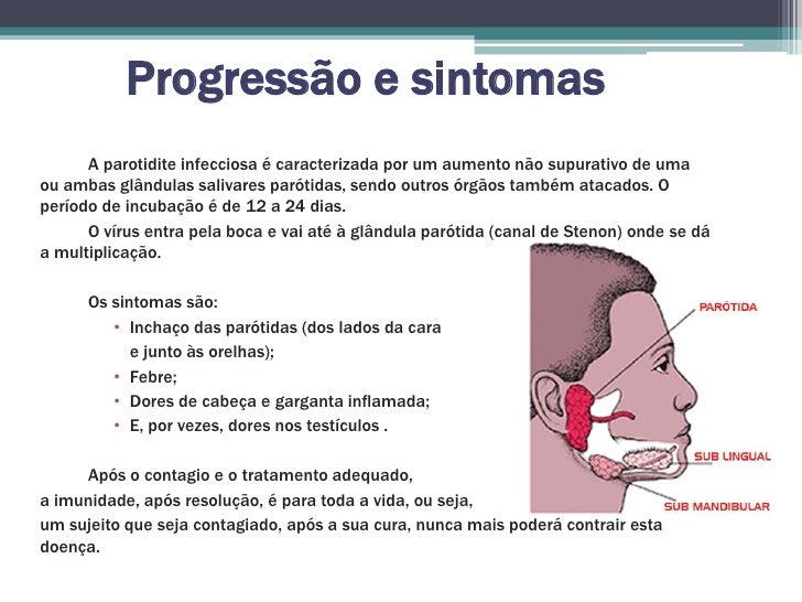 Parotidite Epidémica