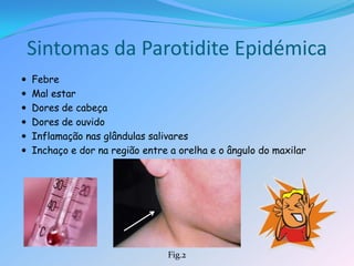 Parotidite Epidémica | PPT