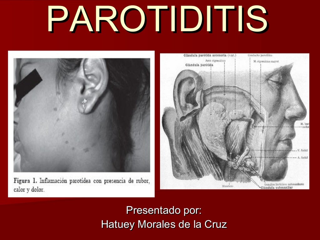 Parotiditis