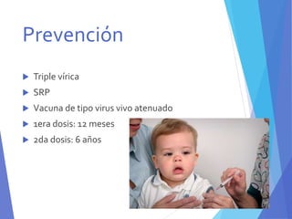 Parotiditis | PPTX