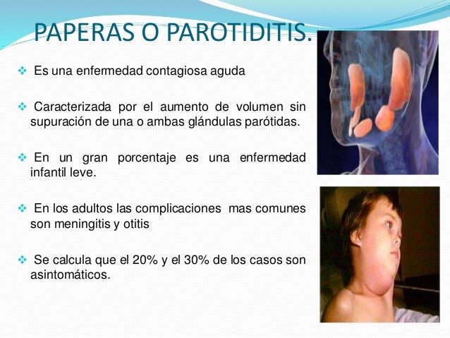 Parotiditis Que Es