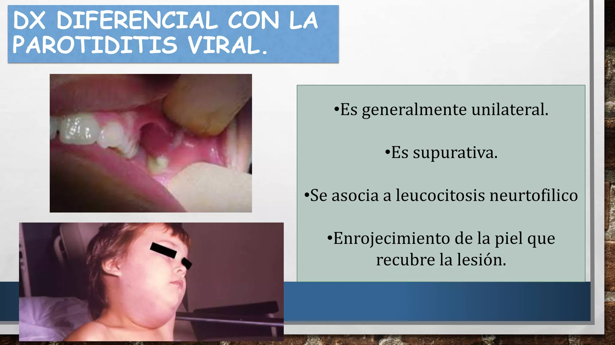 Parotiditis Bacteriana | PPT | Descarga Gratuita