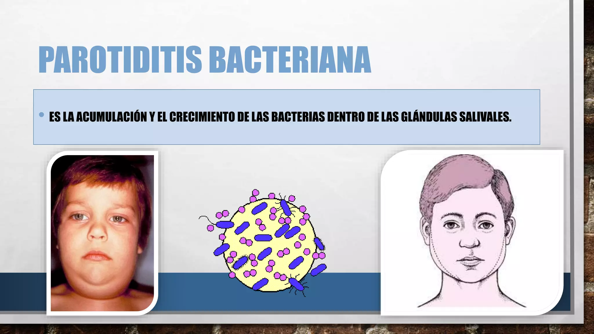Parotiditis Bacteriana | PPTX