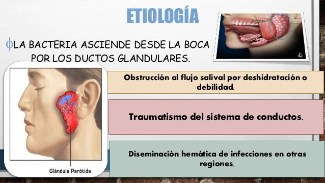 Parotiditis Bacteriana