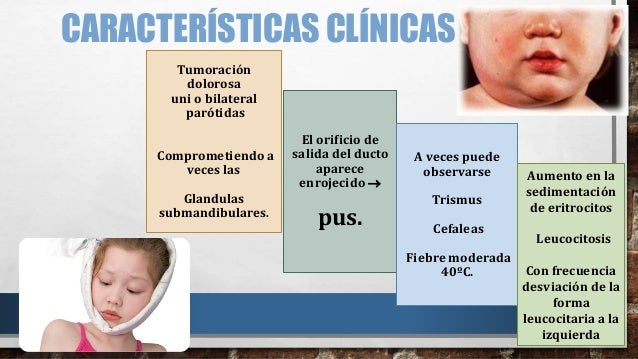 Parotiditis Bacteriana