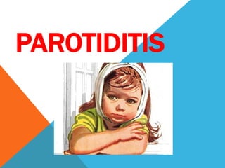 Parotiditis | PPTX