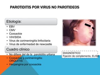 Parotiditis | PPT