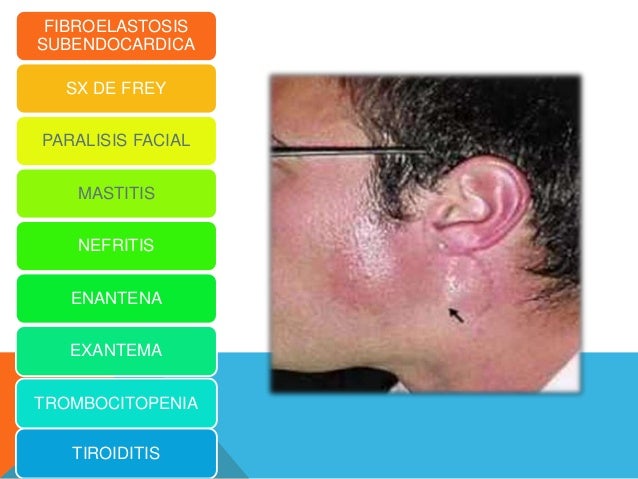 Parotiditis Que Es