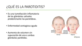 PAROTIDITIS.pptx
