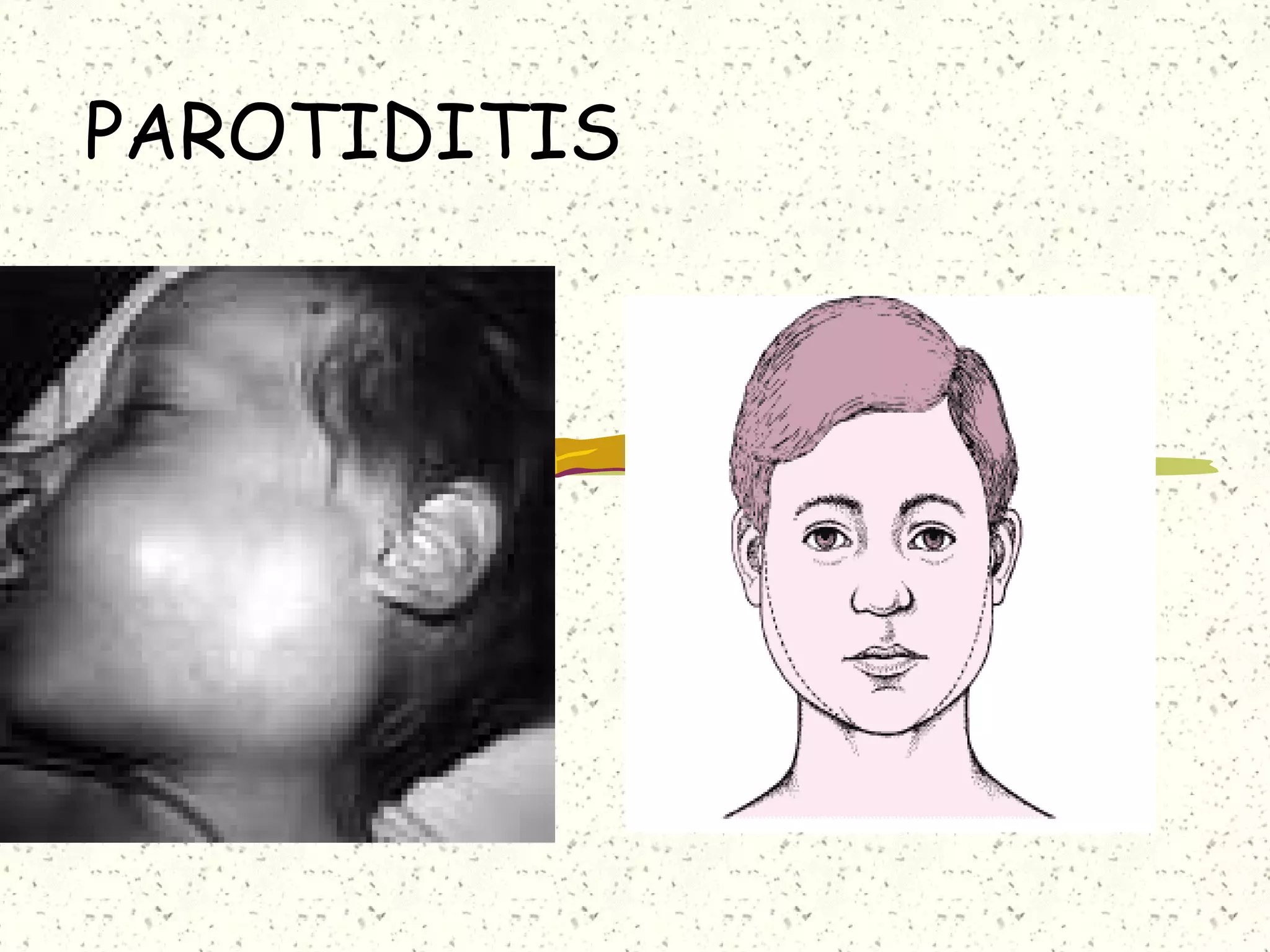 Parotiditis sarampion rubeola | PPT