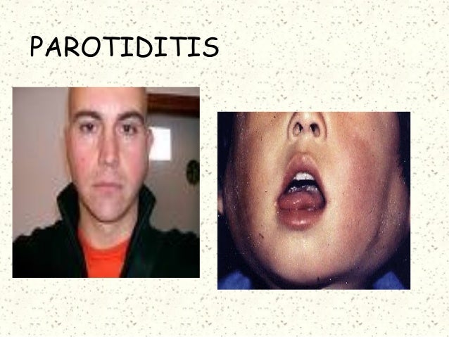 Parotiditis