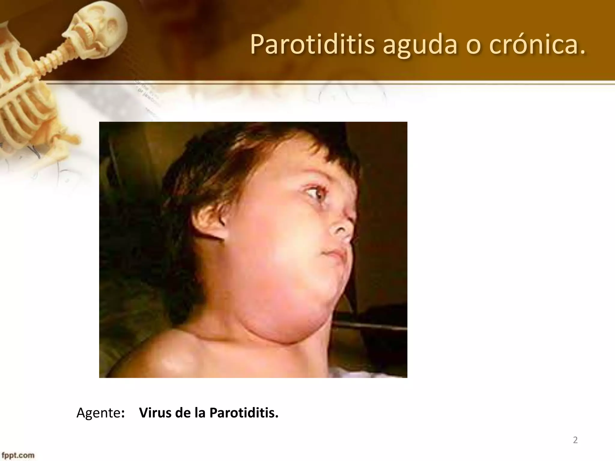 Parotiditis aguda | PPT