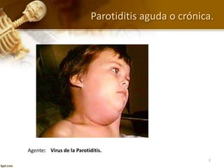 Parotiditis aguda | PPTX