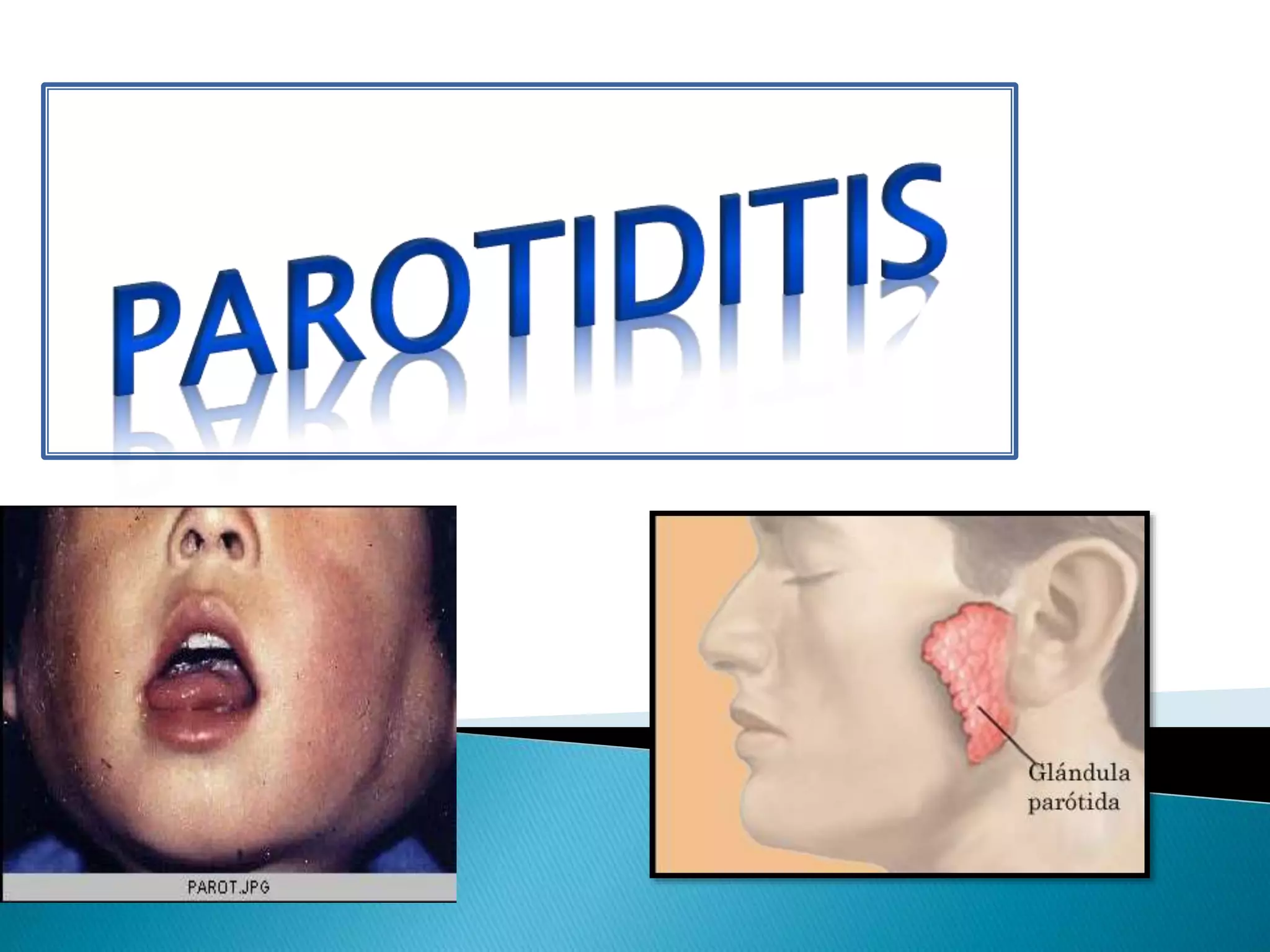 Parotiditis Taller de Salud y Ambiente. | PPTX