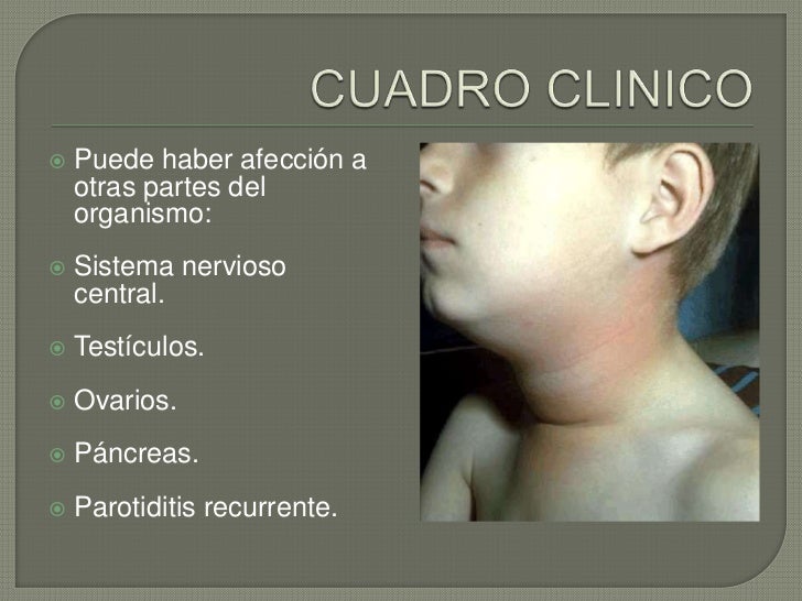 Parotiditis Que Es